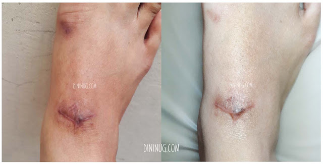 Dermatix Ultra, Efektifkah Untuk Menghilangkan Bekas Luka? - HD Gallery