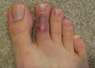 VittoriFootAnkleSpecialist: How to Tell if You have a Broken Toe