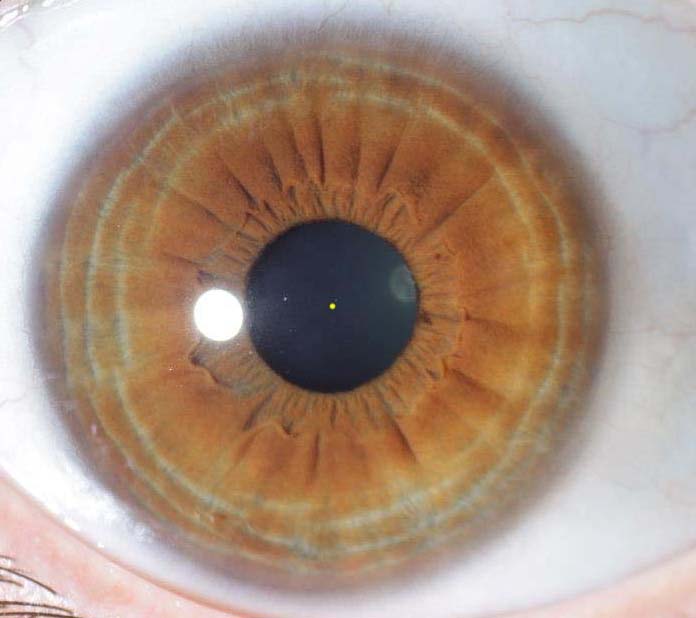 Modern & Multidimensional Iridology: Sectoral Opening - Multiple Breaks ...