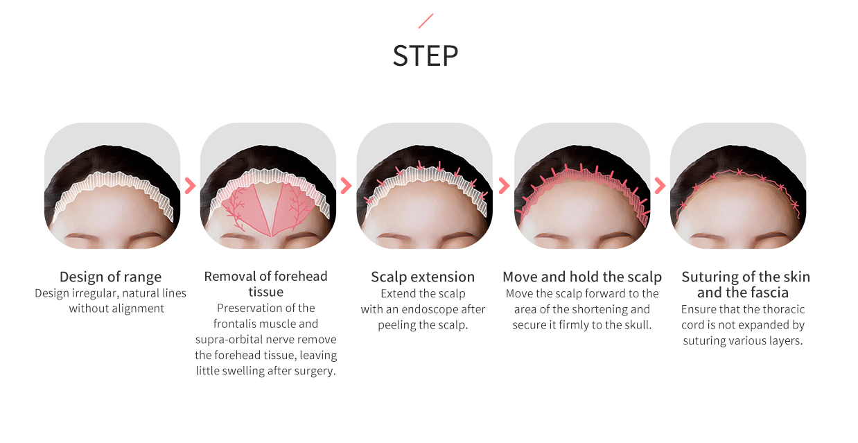 [ATOP Plastic Surgery Korea] Forehead Reduction (Forehead shortening ...