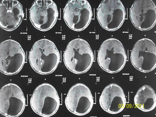 Neurosurgeon India: Left hemispheric porencephalic cyst with raised ICP