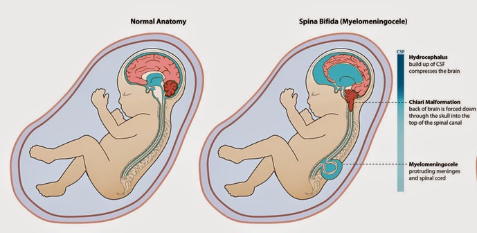 Prepare for Medical Exams : Neural tube Defects - A Case Study