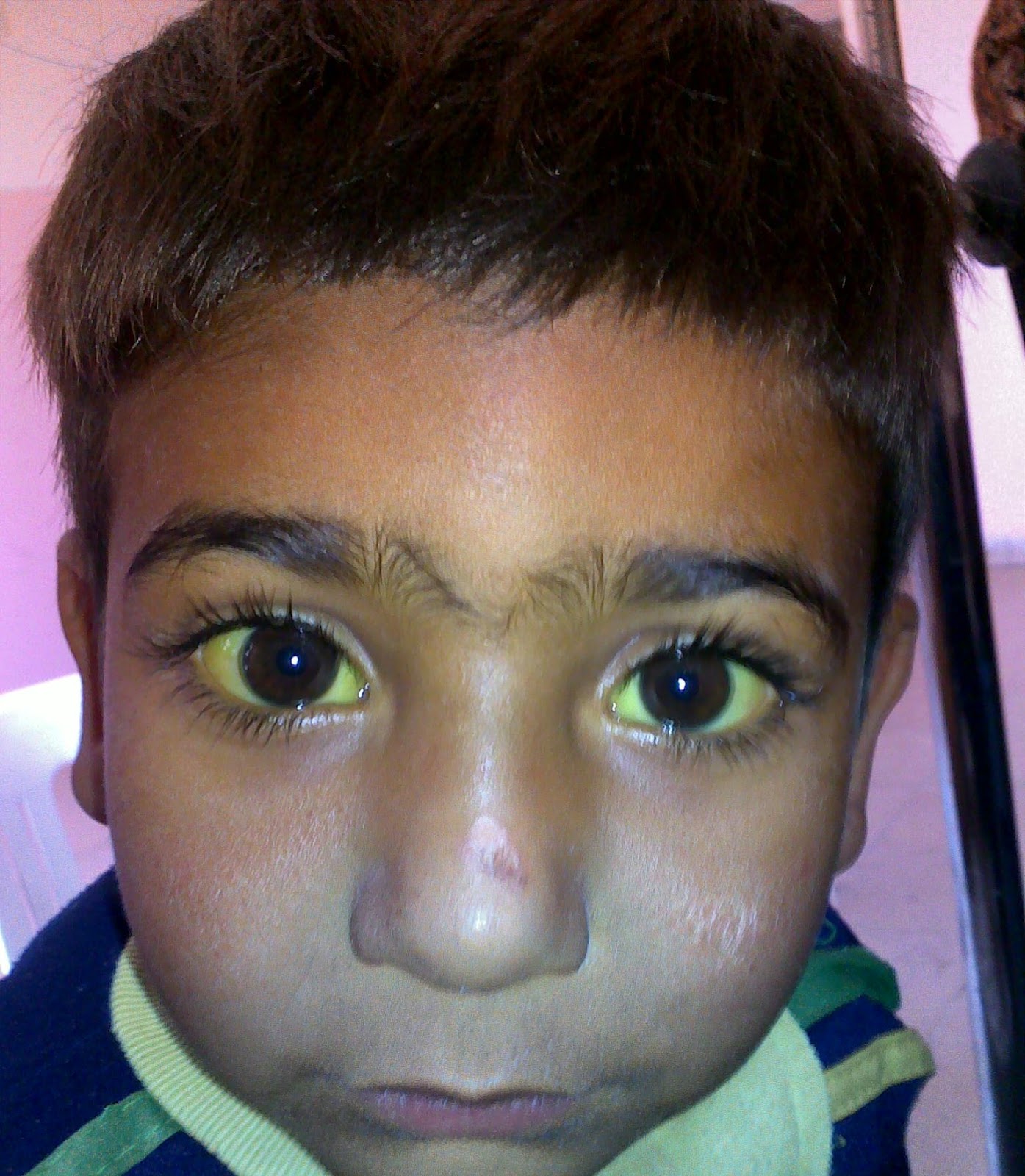 Approach to a patient with jaundice - Dr VIVEK's blog