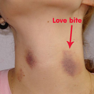 Kenapa lovebite berbahaya? - MiJiE BLoG