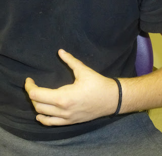 Pollicization at 15 years | Congenital Hand and Arm Differences ...