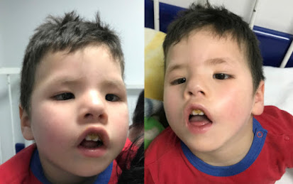 Síndrome de Moebius