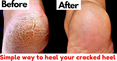 Natural and Easy Way To Heal Cracked Heels.