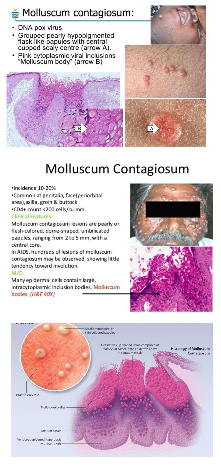 Molluscum Contagiosum