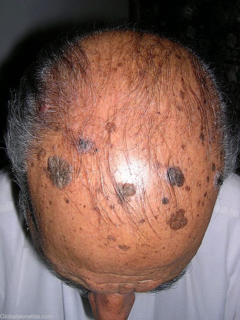 SKIN DISEASE TYPES: Seborrheic Keratosis (Skin Disease Type)