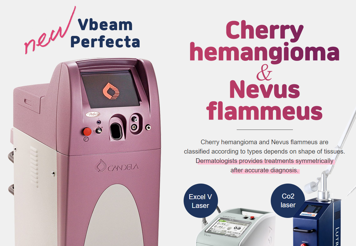 Renewme Skin Clinic: NEW Vbeam perfecta for cherry hemangioma & Nevus ...