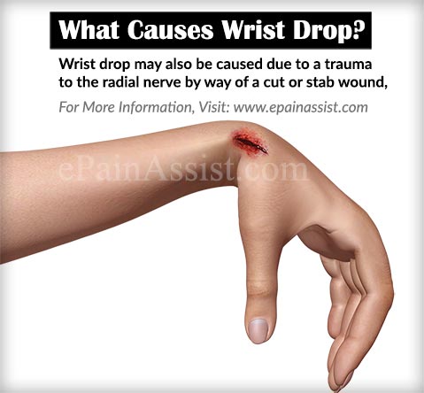Wrist drop - #medical article #anatomy - LANKA STUDENTS