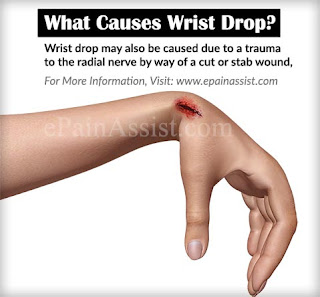 Wrist drop - #medical article #anatomy - LANKA STUDENTS