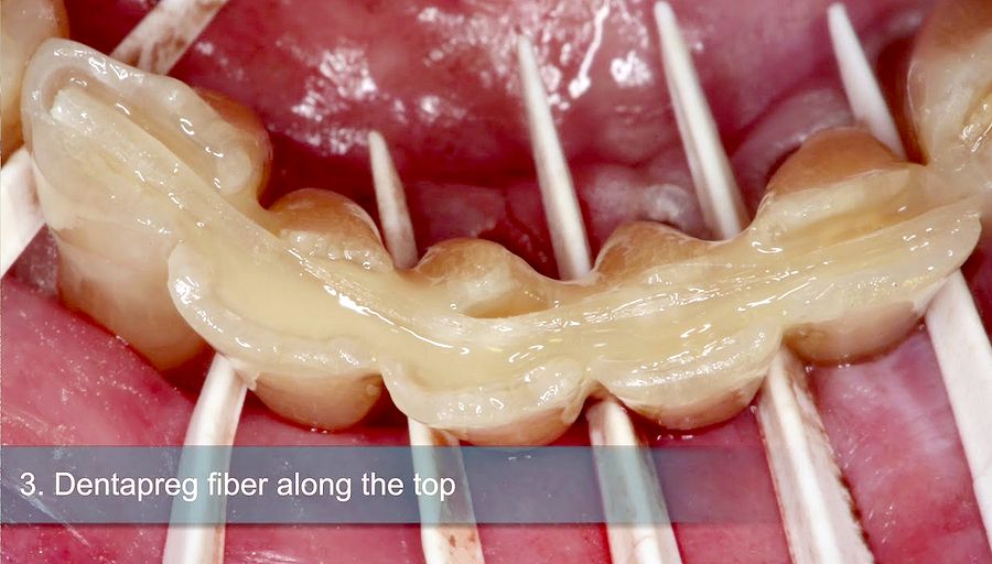 PERIODONTAL SPLINTING: Minimally Invasive and Affordable Splinting - Dr ...