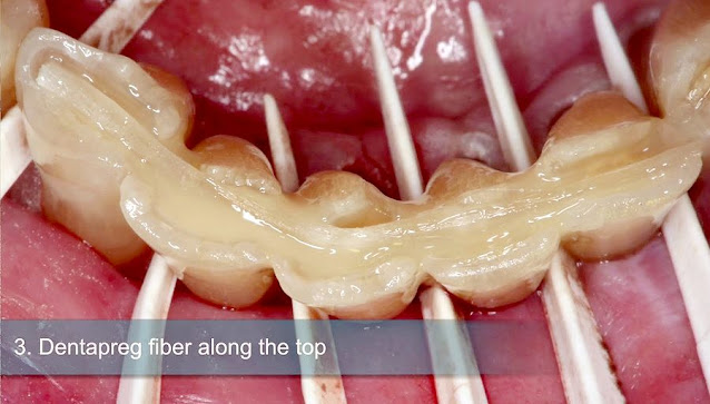 PERIODONTAL SPLINTING: Minimally Invasive and Affordable Splinting - Dr ...