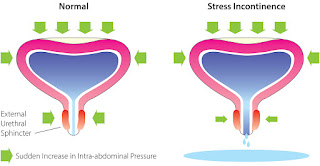 URINARY INCONTINENCE