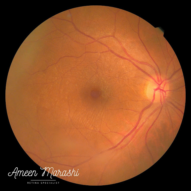 Macular pseudohole