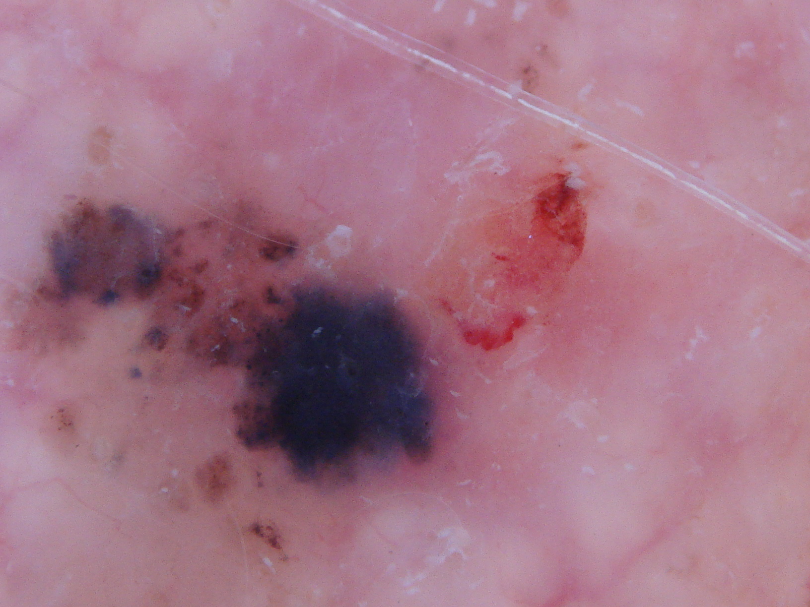 Dermoscopy Features as Clues: Dots Blue Grey