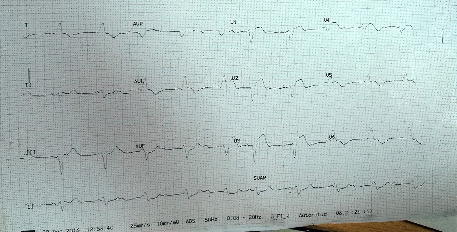 Cardiology window: AWMI with CHB
