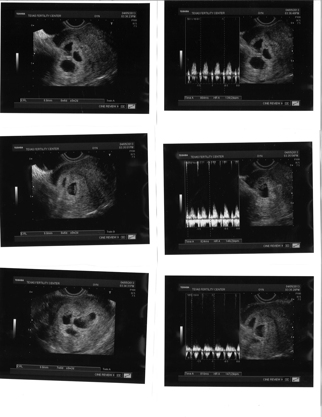 The Texas Trio: A Triplet Pregnancy Blog: Early ultrasound pictures