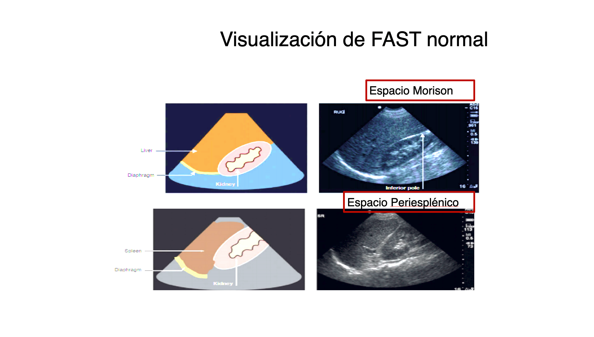 ZONA DE SALUD DE OFRA: Emergency Room Academy. Ultrasonido FAST en ...