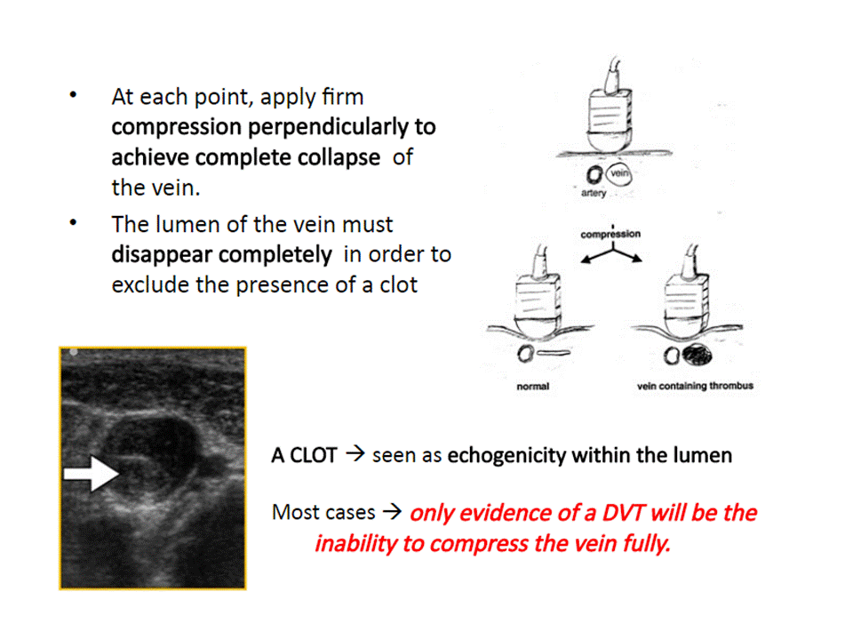 BÀI SOẠN VỀ SIÊU ÂM CHẨN ĐOÁN: Acute and Chronic DVT and Ultrasound (US)
