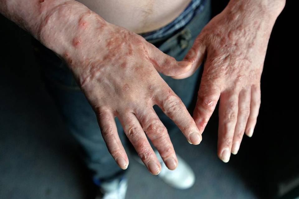 Brave New World: Burn Types