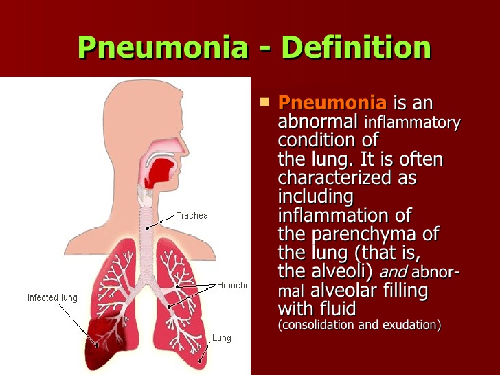 Mengenal Pneumonia - sawarna hidup