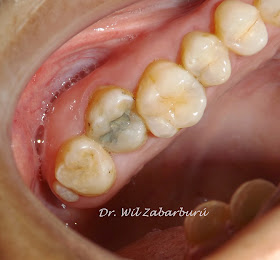 CLINICA DENTAL ASISTENCIAL: DISTOMOLAR