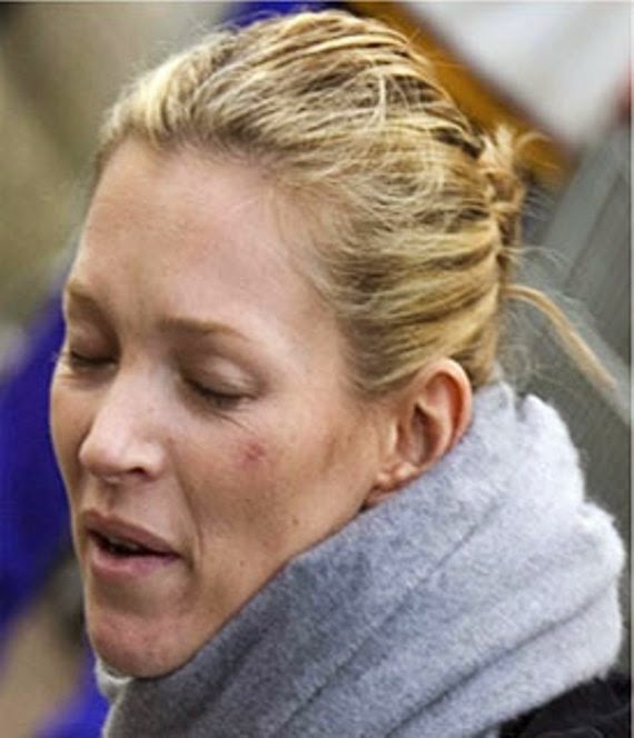 Kate Moss Acne Picture - Acne Picture