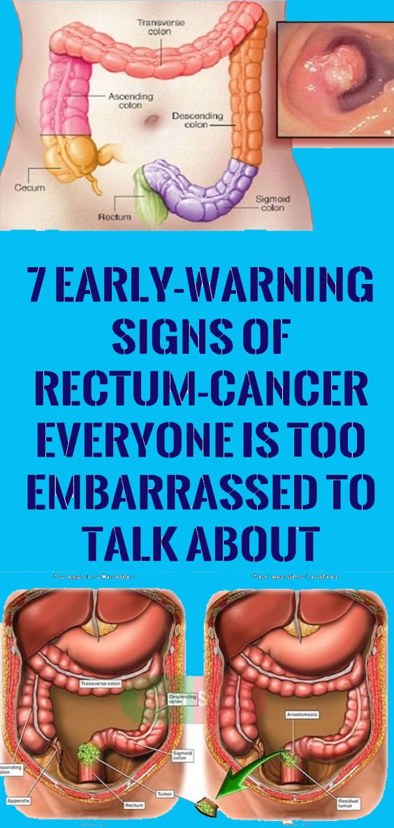 Don’t Ignore These 6 Signs That May Indicate Anal Cancer - Healthy ...