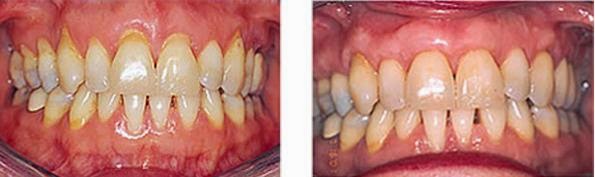 Omni Dental Group: Splinting Teeth