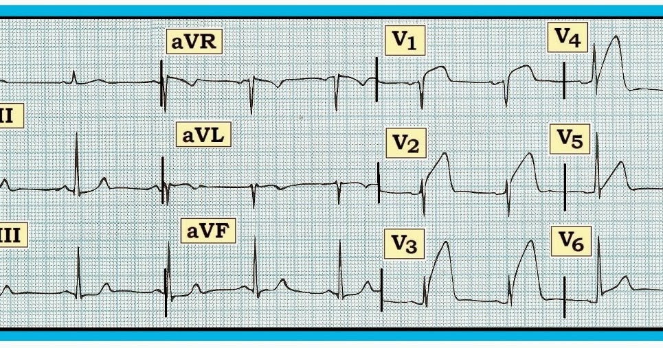 ECG Interpretation: ECG Interpretation Review #82 (Acute STEMI – RCA ...