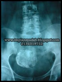 MY COLORFUL LIFE: FIBROID, tanda-tanda dan rawatan alternatif