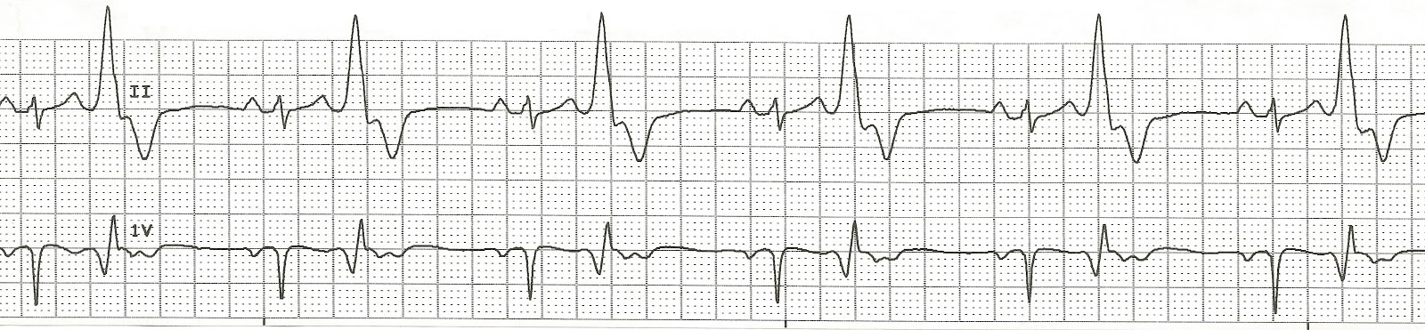 EKG Rhythm Strips 81: Bigeminy, Trigeminy, Quadrigeminy...
