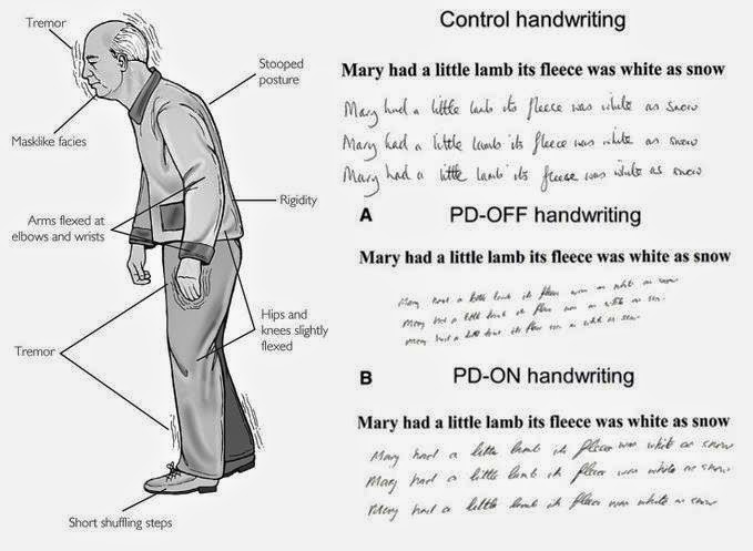 AMBS: A Deep Look At Amarantus’ Phase 2b Eltoprazine For Parkinson’s ...