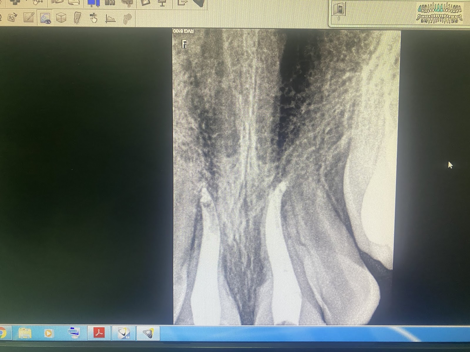 Management of External Inflammatory Root Resorption By MTA