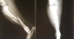 what is Comminuted Fracture ? Comminuted Fracture Definition Symptoms ...