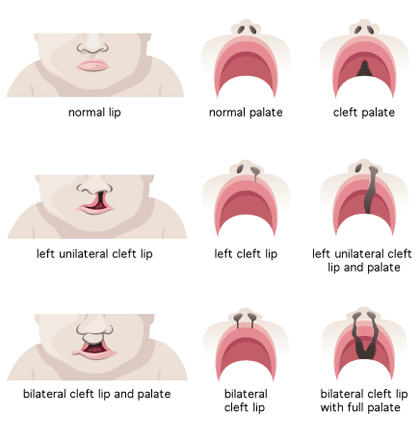 Omni Dental Group: Cleft Lip and Palate
