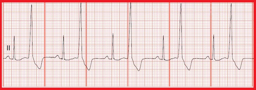 Practice EKG Rhythm Strips 182