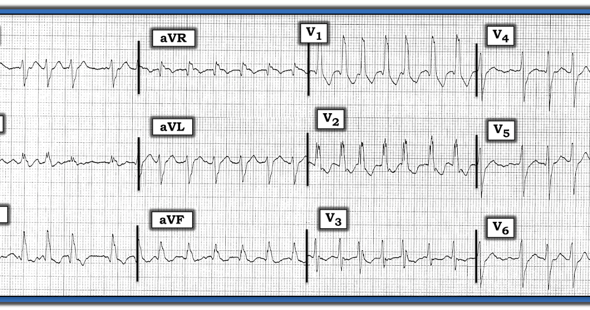ECG Interpretation: ECG Blog #219 (ECG MP-36) — Is this an Irregular VT?