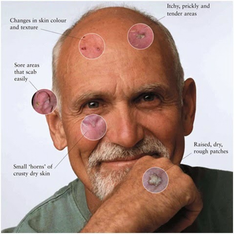 ¿CUÁL ES EL MEJOR TRATAMIENTO DE LAS QUERATOSIS ACTÍNICAS?