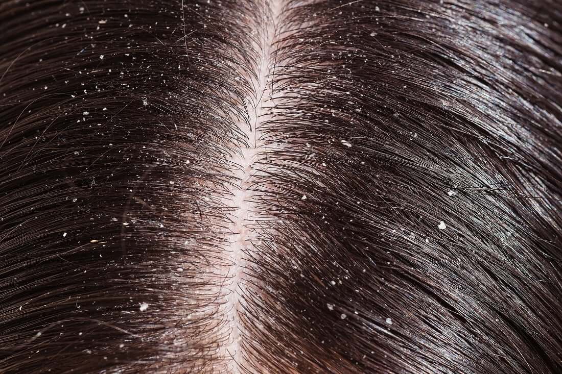 A Brief Overview Of Dandruff vs Dry Scalp Comparison