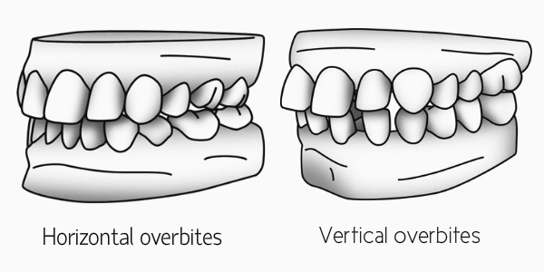 Which One To Choose among Invisalign, Braces and Surgery to Fix ...