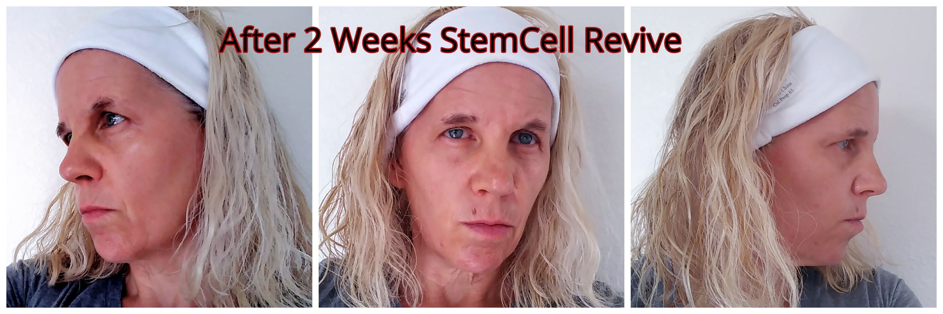 Here are the photos of my after 2 weeks