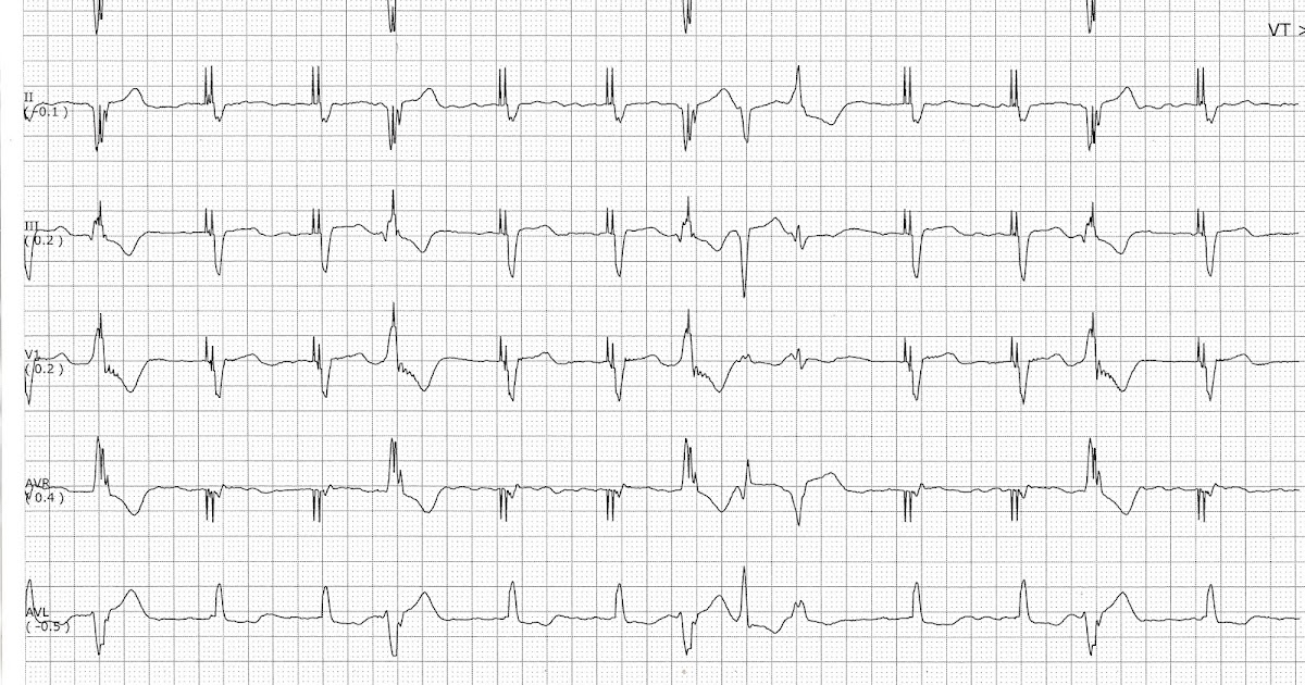 Biventricular Pacing with Trigeminal PVCs
