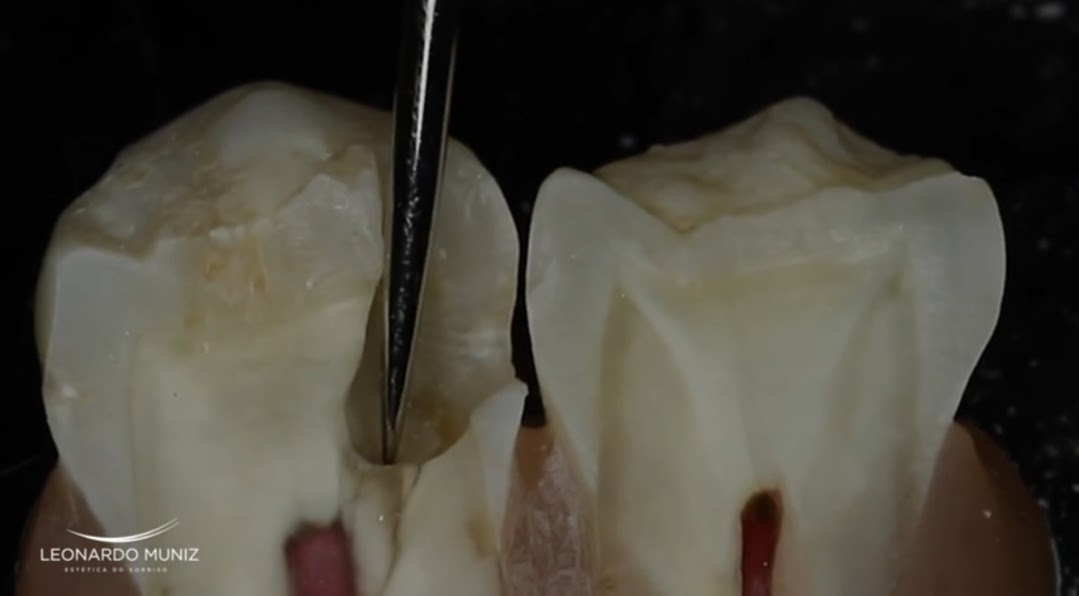 Dentística: Slot vertical