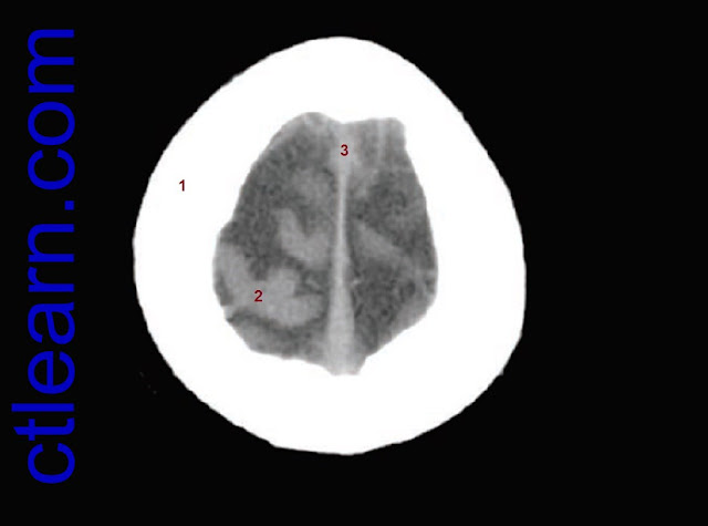 Anatomy CT Axial Brain