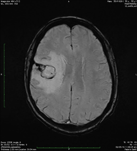 Ultimate Radiology : Frontal lobe abscess : follow up MRI