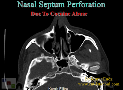 Health Zone Turkey: Symptoms, Causes and Diagnosis of Nasal Septum ...