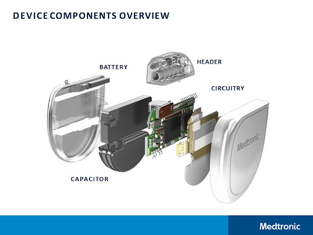 CVT Mohd Farid: Concept Of ICD Technology-Sensing & Detection-Medtronic ...